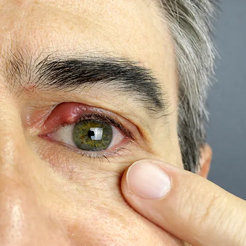 Calázio – o que é, sintomas e como prevenir o surgimento na pele