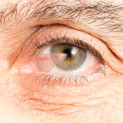 Pterígio – o que é, sintomas e como tratar a condição ocular